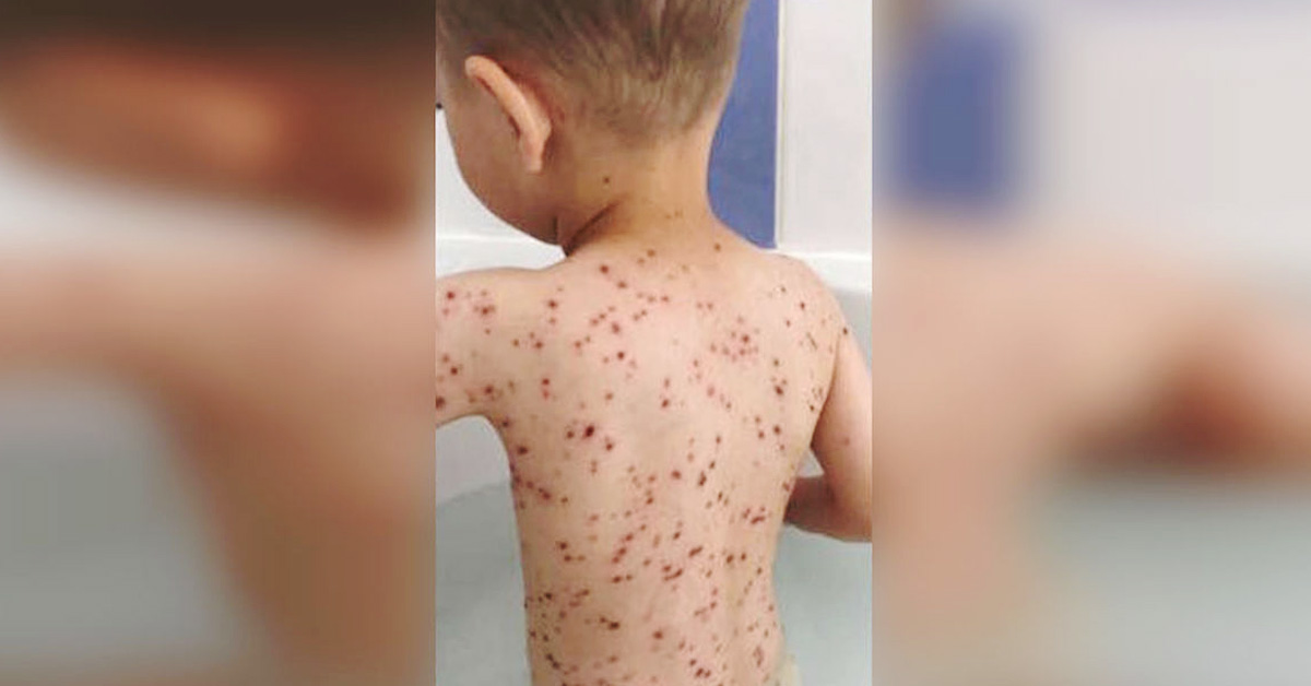 Cómo tratar la varicela en niños y qué cosas no hacer